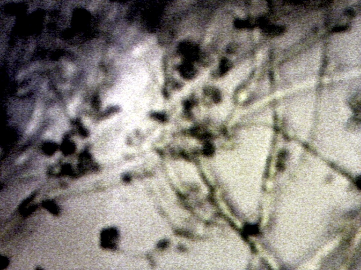 MORGELLONS AND RECENT FINDINGS – Carnicom Institute